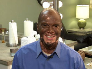 ‘Turning White’: Detroit Newscaster Lee Thomas and Others with Vitiligo ...